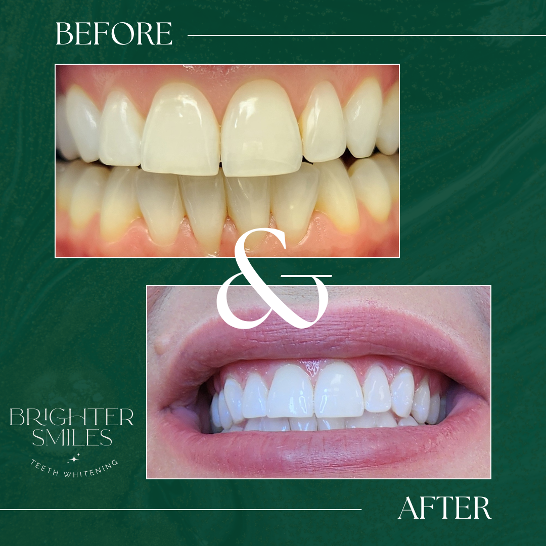 Brighter Smiles Teeth Whitening Advanced Home Whitening System